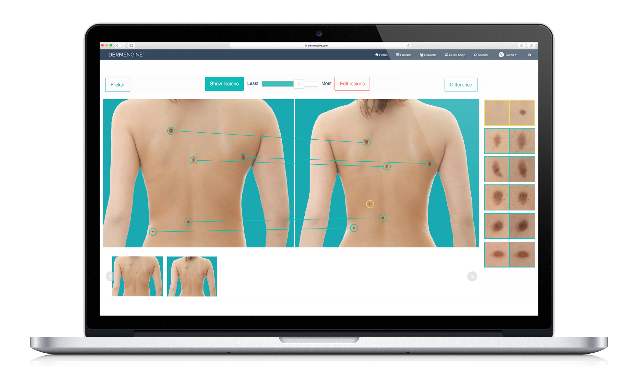 Total Body Photography For The Early Detection Of Skin Cancer